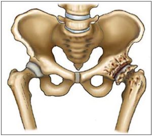 Coxartroza: care sunt semnele ascunse și cum să le recunoști la timp ...